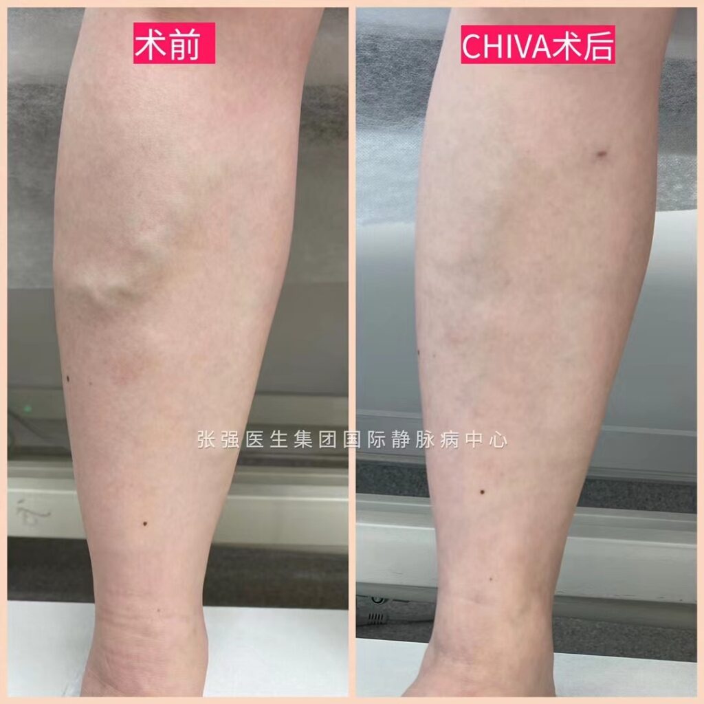 Why CHIVA Offers a Better Cosmetic Solution | Global Advances in Phlebology