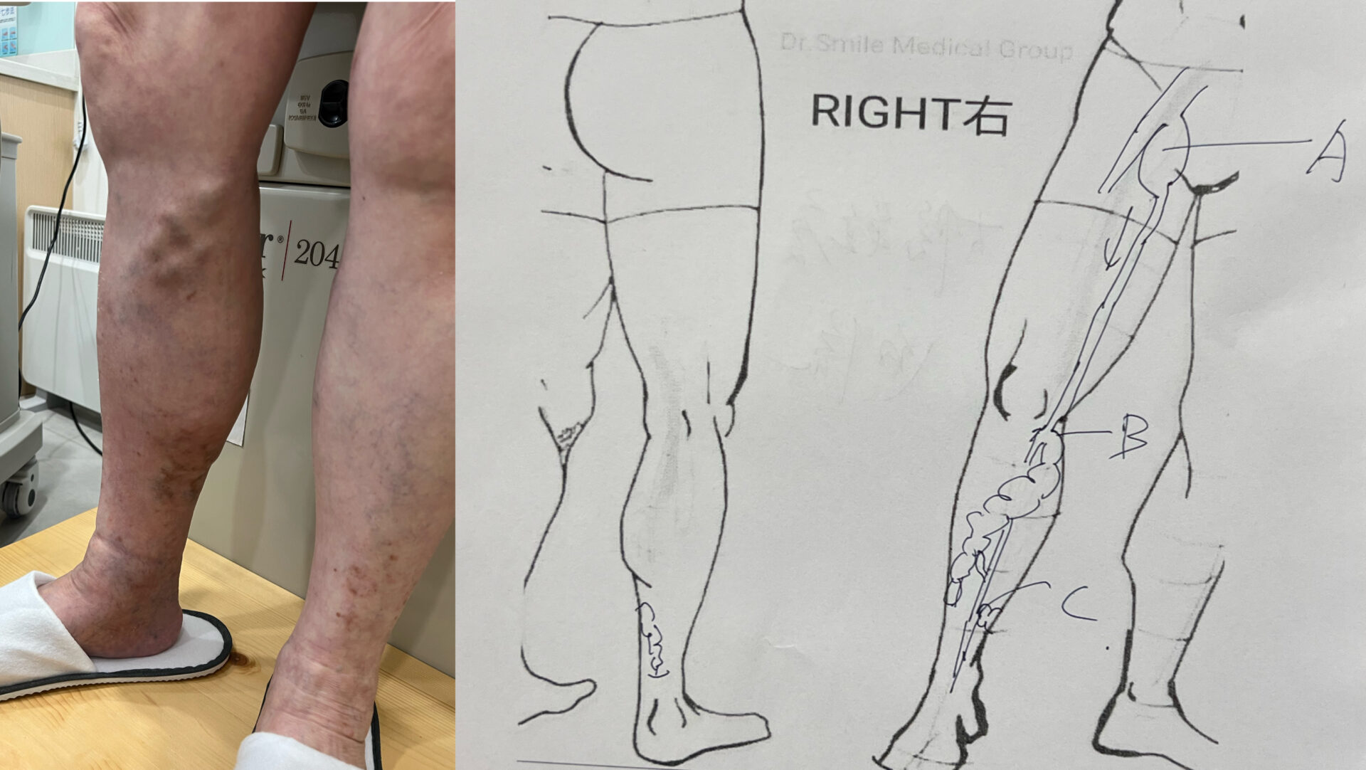 CHIVA Treatment for Varicose Veins Without Stopping Anticoagulants ...