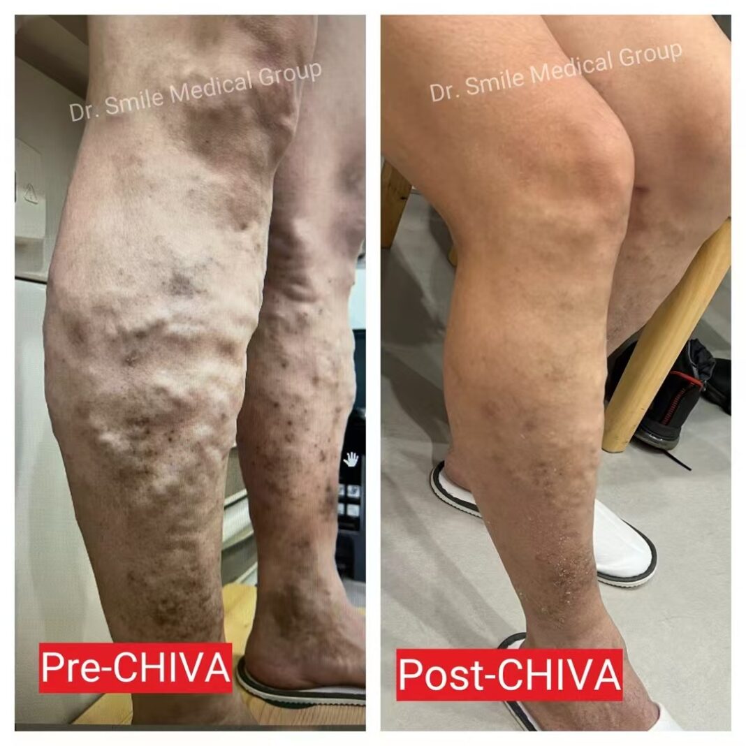Biopsychosocial Perspective: Why CHIVA is the Optimal Treatment for ...